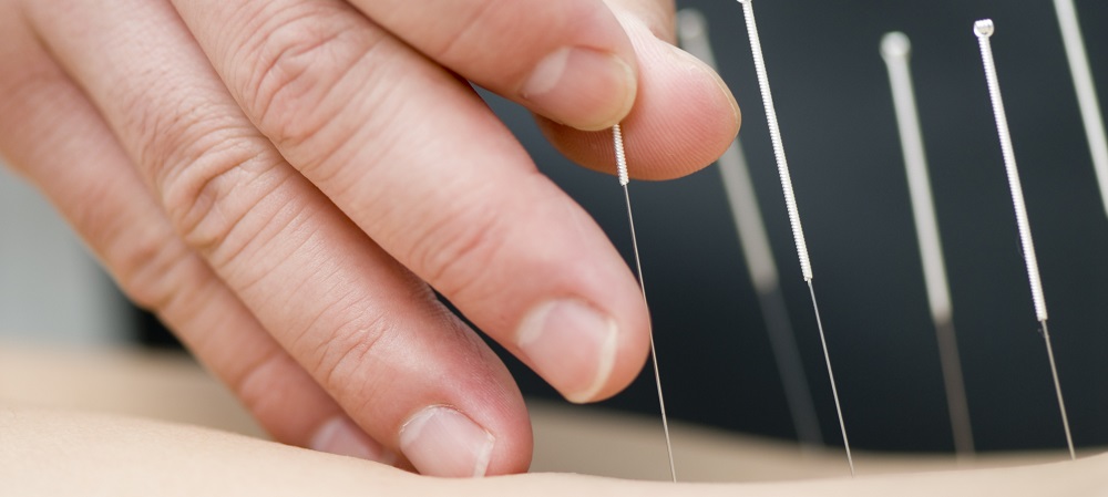 Here’s Why Acupuncture Treatments Are Great for You - Solea Medical Spa