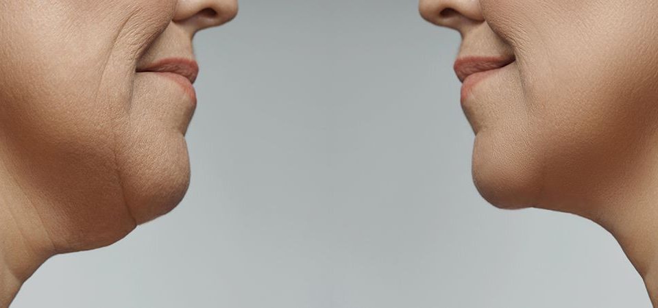 Kybella: Cost, Side Effects, Before and After - Solea Medical Spa